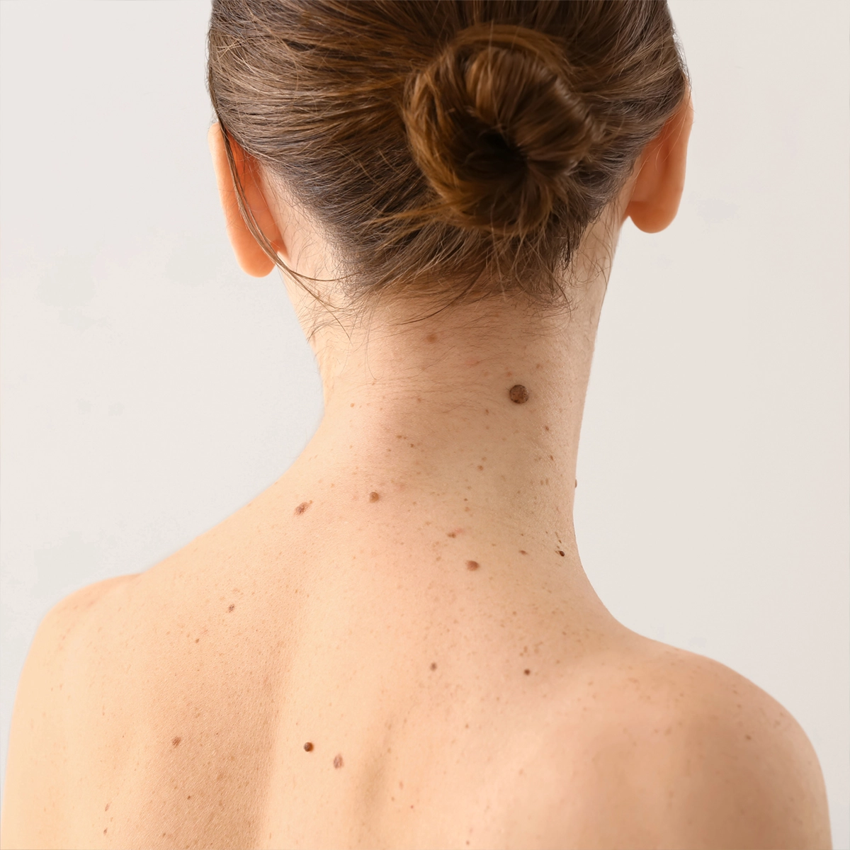 Muttermale | Louis Widmer