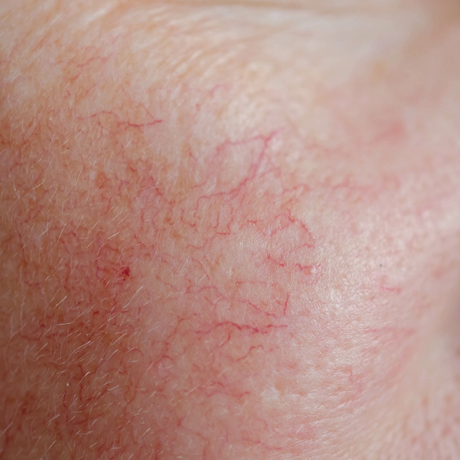 Rougeur de la peau, rosacée et couperose | Louis Widmer