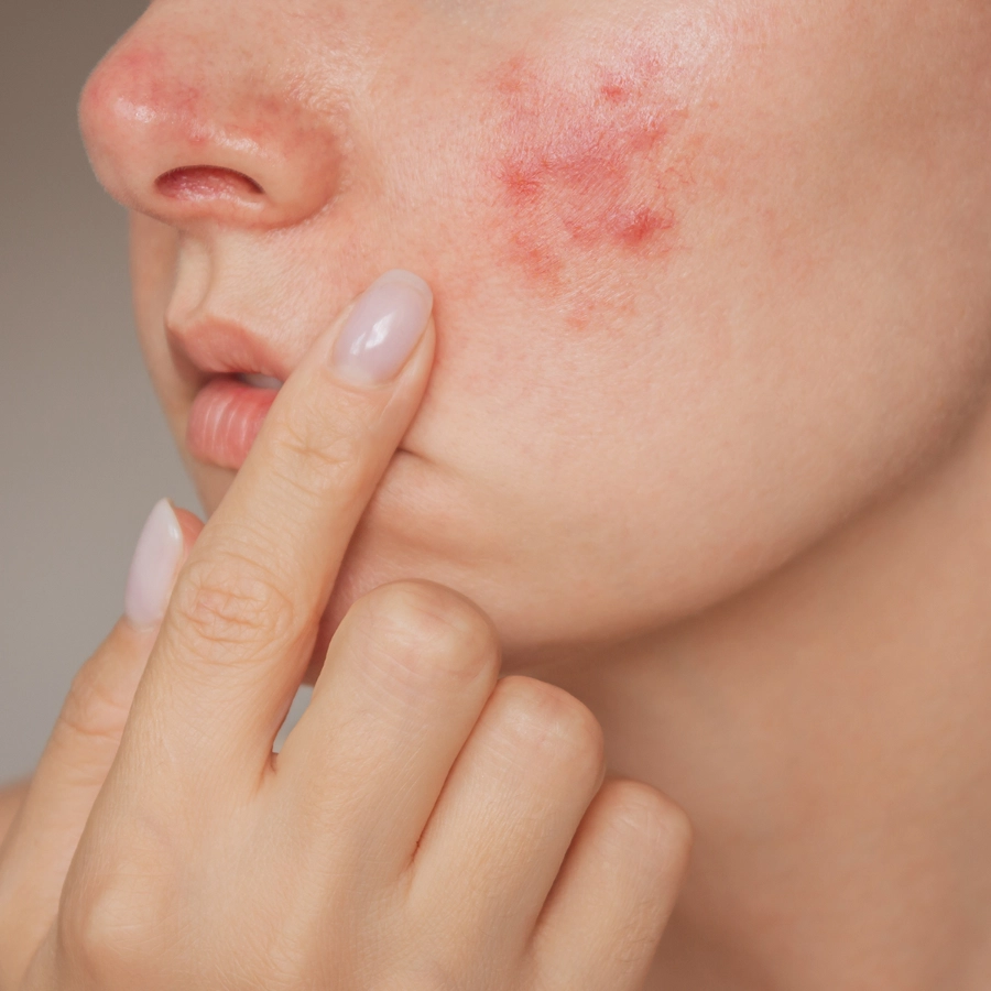 Seborrhoea | Louis Widmer