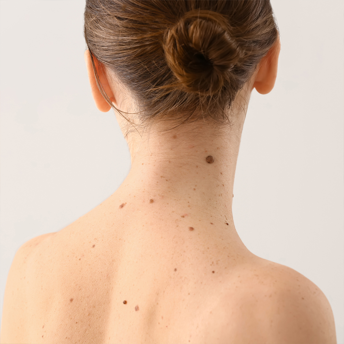 Muttermale | Louis Widmer